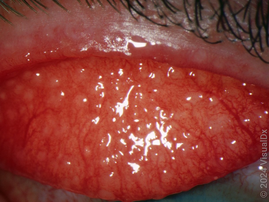 How Long Does Pink Eye Last? Pictures and Recovery Tips - GoodRx