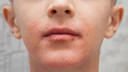 Why Do I Have Small Red Bumps Around My Mouth Infoupdate Why Do I Have Small Red Bumps Around My Mouth Infoupdate