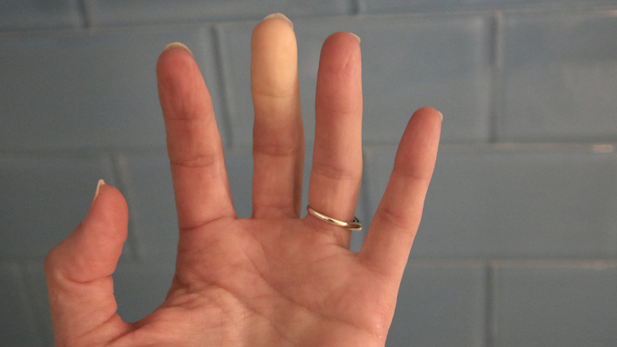 What Is Raynaud’s Syndrome? - GoodRx