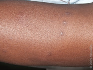 Photos Of Bed Bug Bites On African American Skin Infoupdate Photos Of Bed Bug Bites On African American Skin Infoupdate