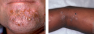 Small Red Spots On Face Not Acne Infoupdate Small Red Spots On Face Not Acne Infoupdate