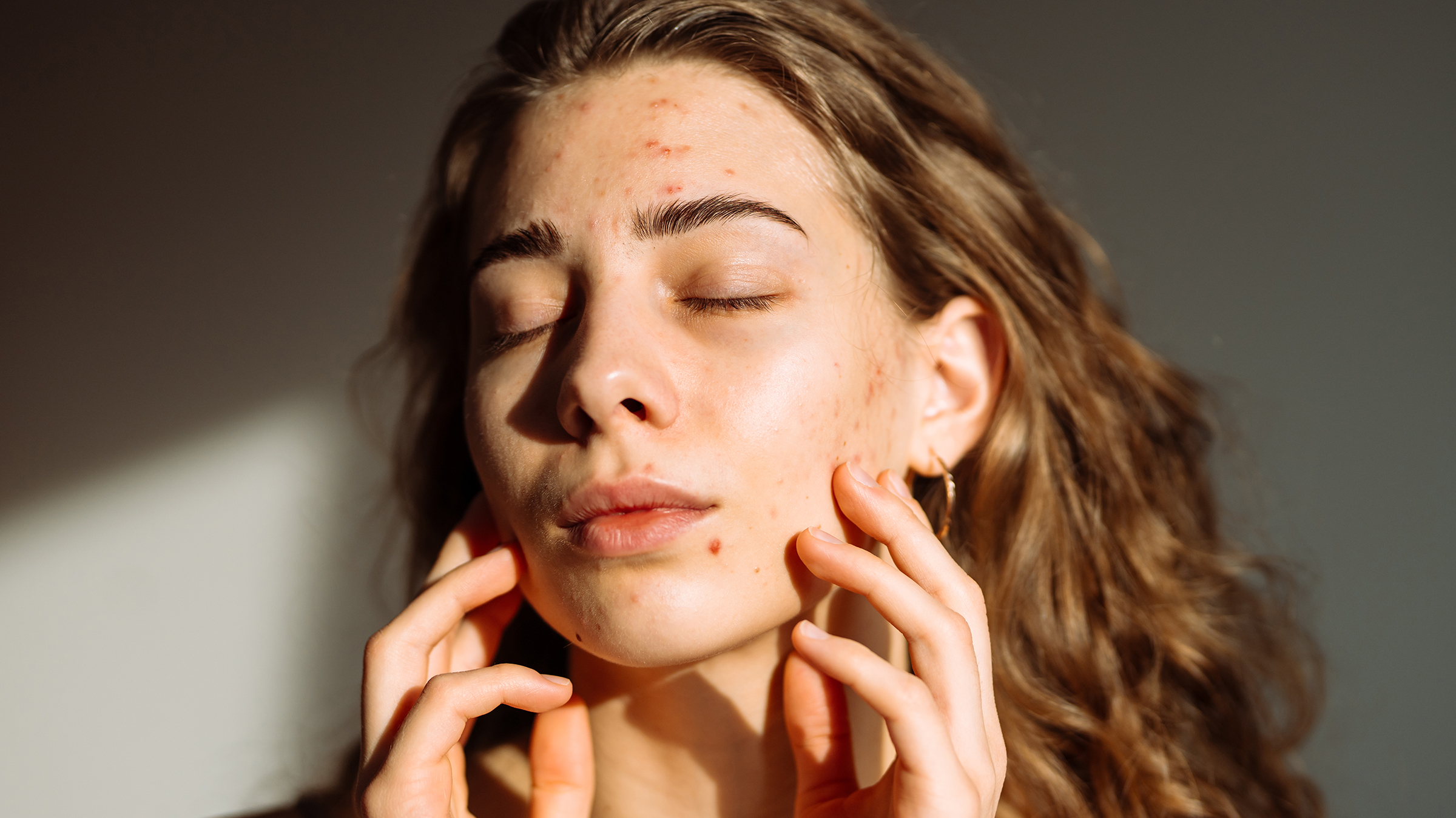 Does Sun Exposure Help or Hurt Acne? - GoodRx