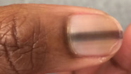 What Do Cancerous Warts On Dogs Look Like What Do Cancerous Warts On Dogs Look Like
