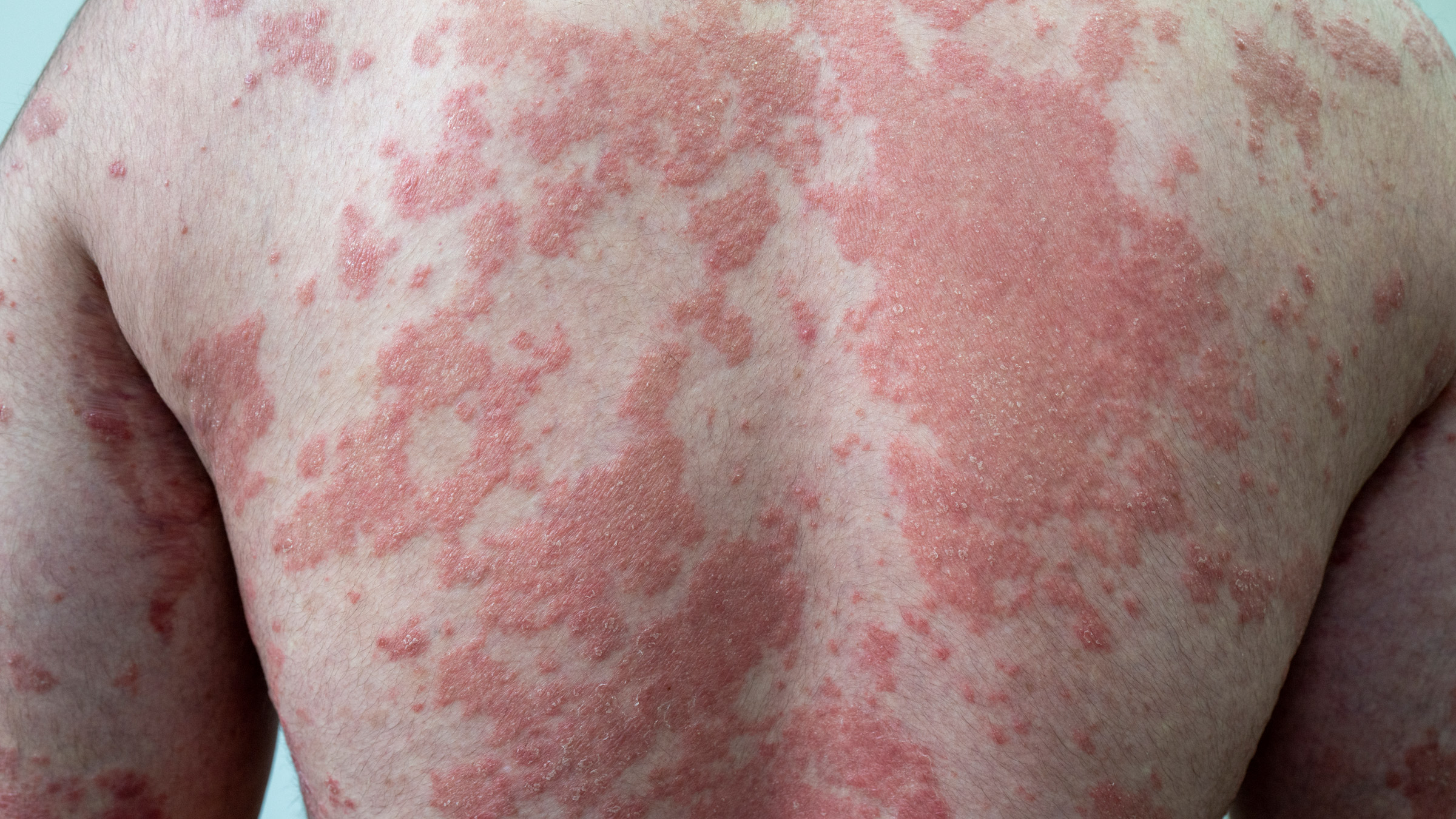 Eczema vs. Psoriasis: What Is the Difference? - GoodRx
