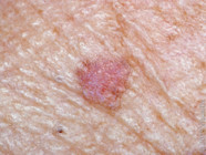 Actinic Keratosis Images Symptoms And Treatment GoodRx