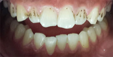 Stained teeth cleaning treatment – Dental Case Study | The Fono
