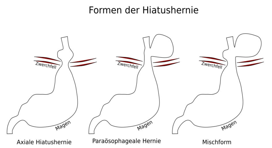 Zwerchfellbruch (Hiatushernie) – Ursache, Symptome, Behandlung - CARA CARE