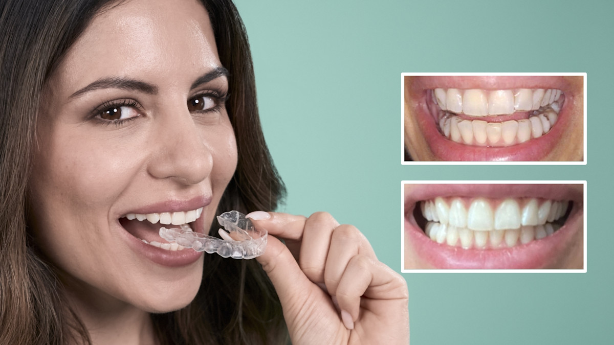 DR SMILE X Impress: Mit unsichtbaren Zahnschienen zu geraderen Zähnen