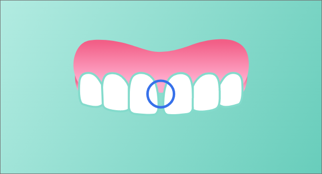 Diasteem | Laat je spleetje tussen de tanden corrigeren | DR SMILE