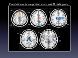 Mitochondrial Dysfunction in Autism: Symptoms & Treatment | Cortica