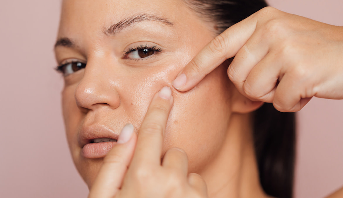 How Long Should You Actually Leave on That Acne-Busting H... | theSkimm