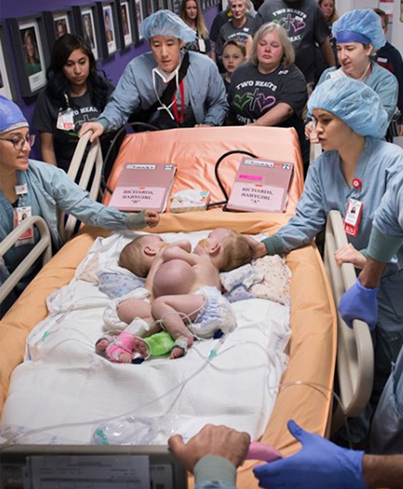 Conjoined Twins Pregnant Separated