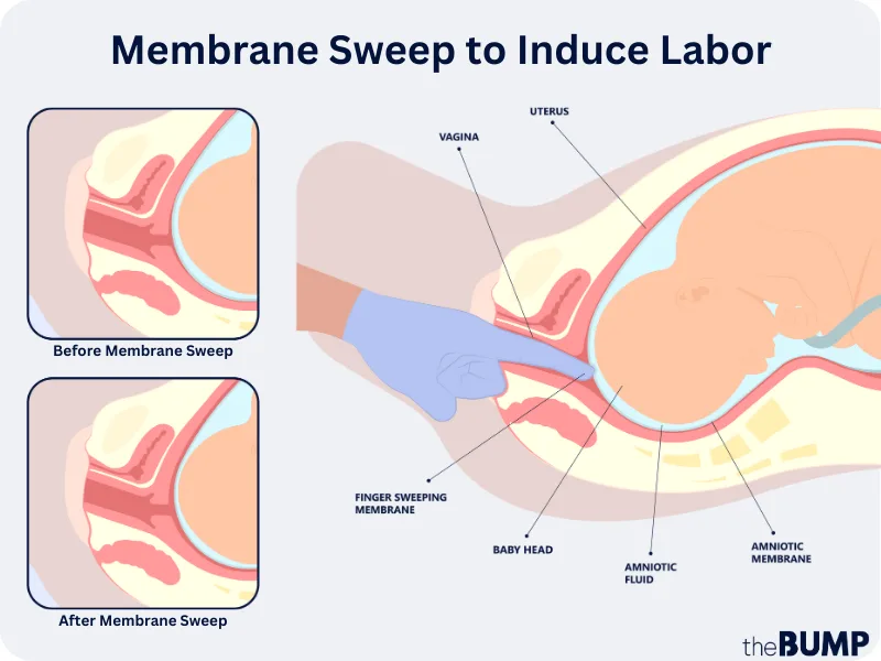 What Is a Membrane Sweep? Stripping Membranes, Explained