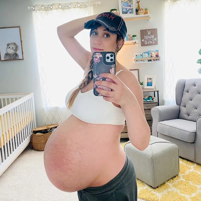 Puppp Rash What To Know About This Pregnancy Rash 46 Off