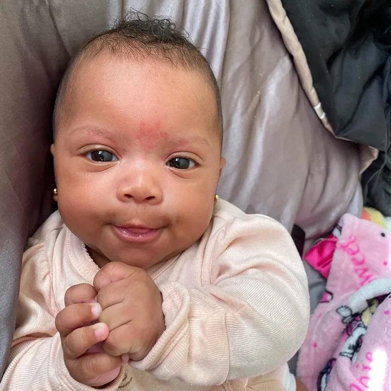 Stork Bite Pictures Causes Effects And More 42 Off