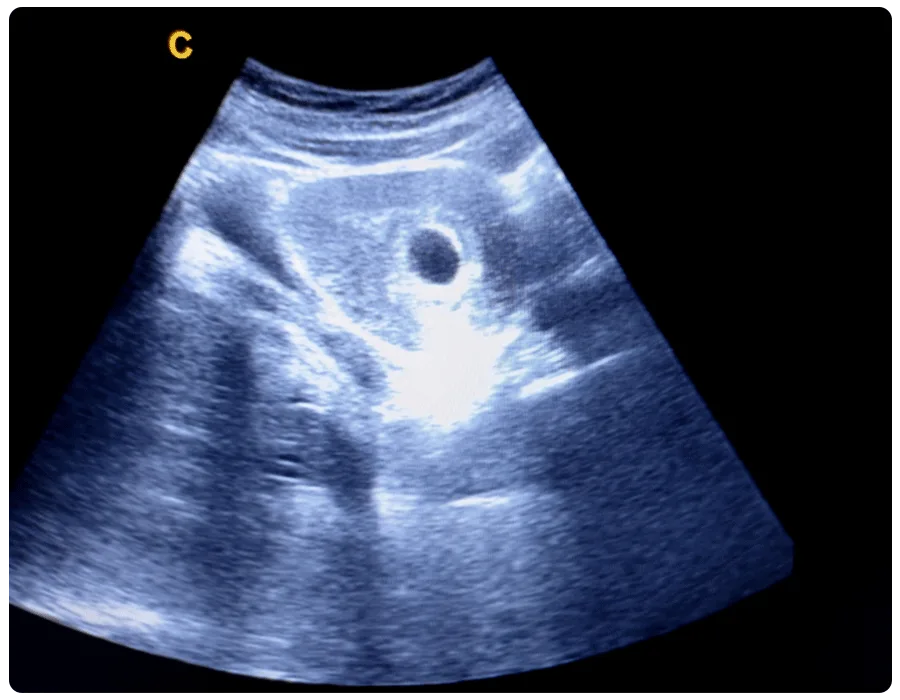 5 Week Ultrasound: Pictures, What to Expect