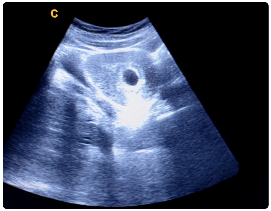 5 Week Ultrasound: Pictures, What to Expect