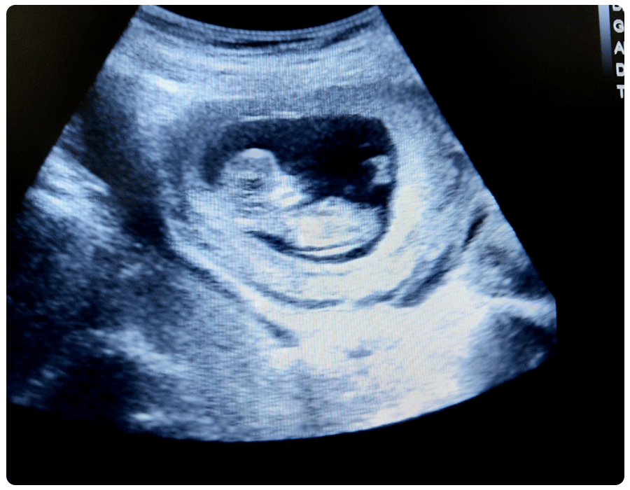11 Week Fetal Ultrasound 112 11 Week Fetus Stock Photos, High Res