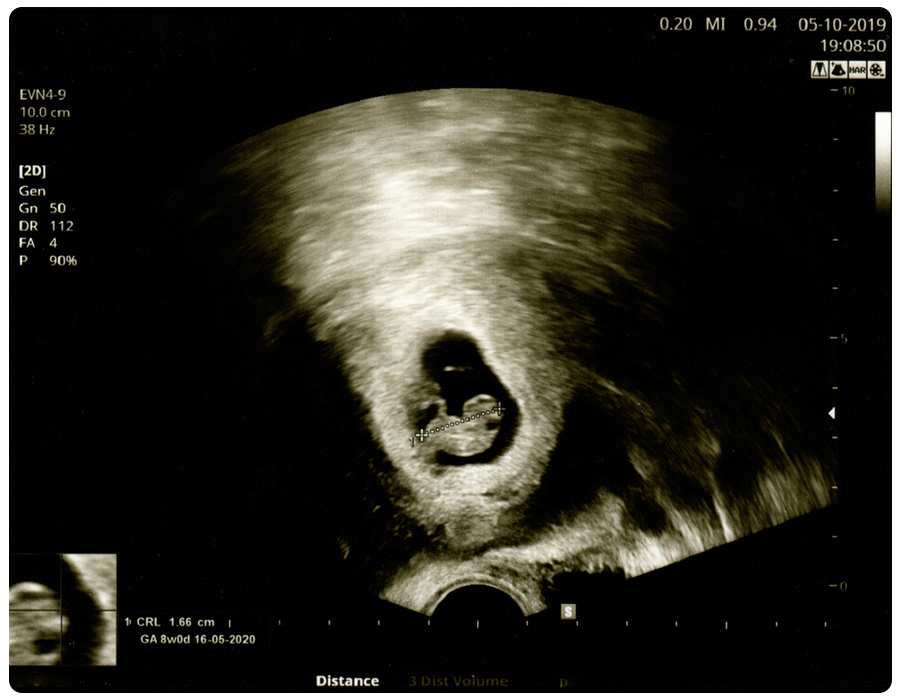 8 Week Old Fetus Ultrasound