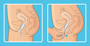 Tampon Instructions Diagram