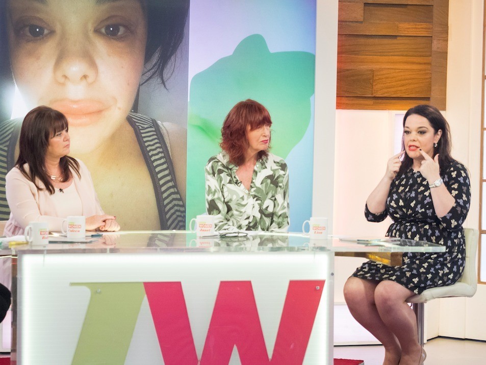 The truth about Lisa Riley's 'trout pout' lips! | Loose Women