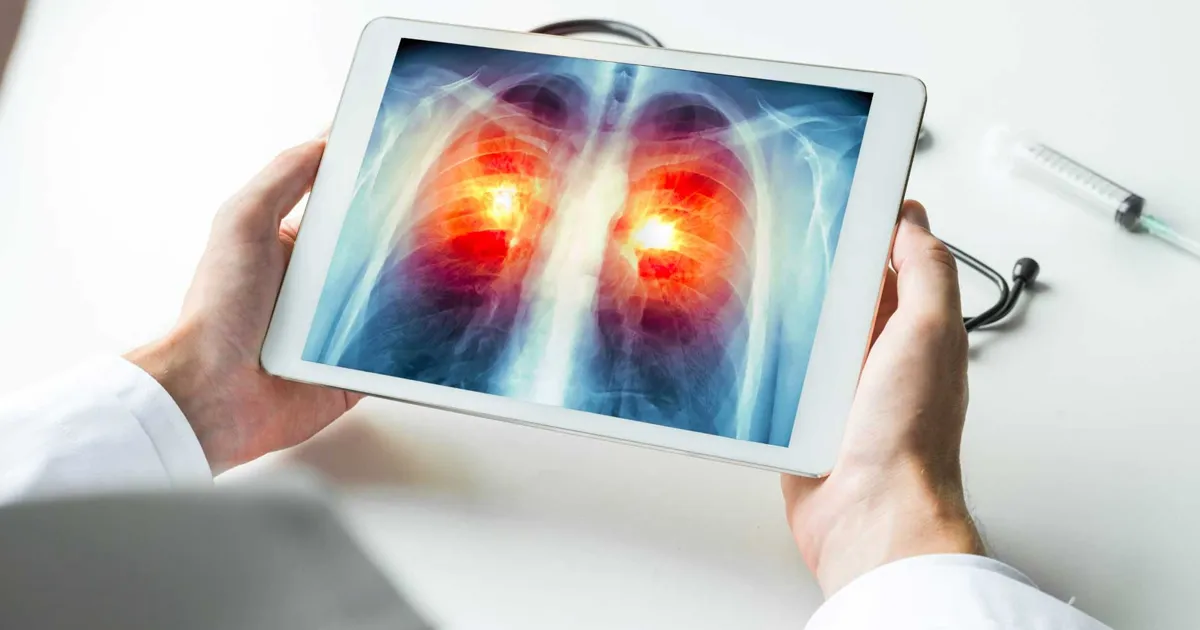 Dr. Oertle Discusses Early Lung Cancer Detection at Envita