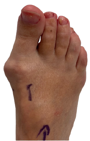 Bunion Scar Tattoos