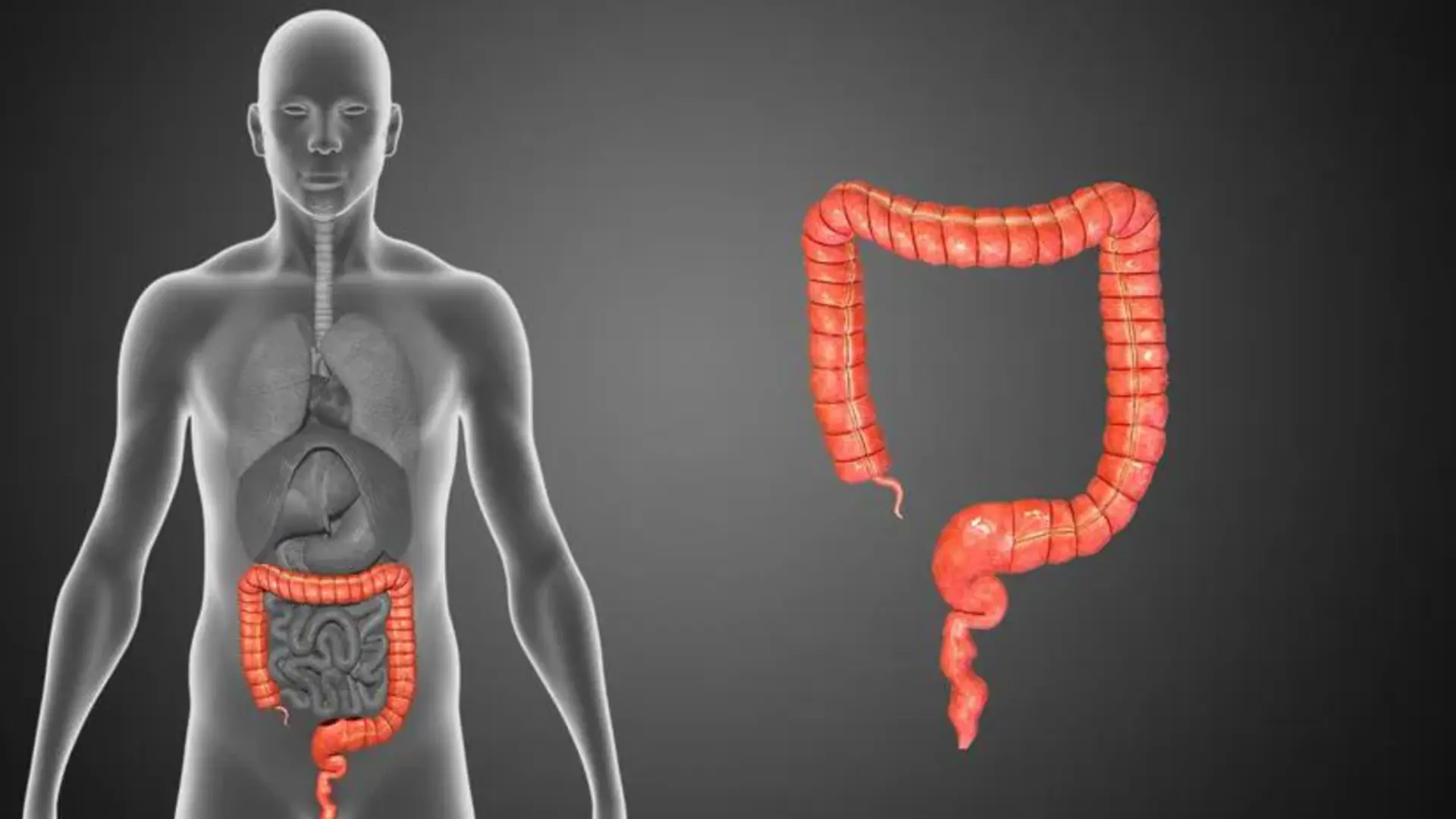 Specyficzne szczepy bakterii E. coli przyczyną raka jelita grubego ...