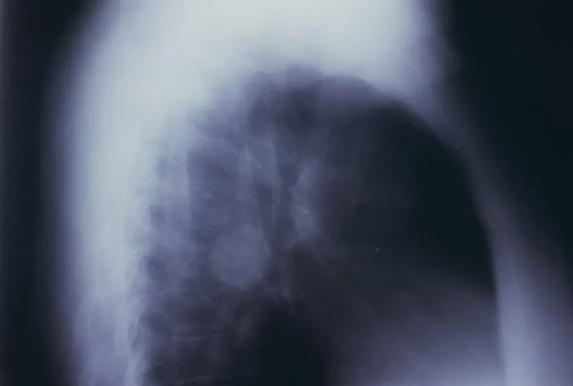 Przerzuty do kości najczęściej obserwuje się w przebiegu raka piersi i ...