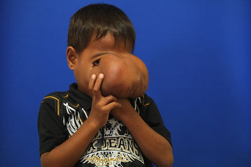 SEE: HUGE tumor removed from boy's face & pics are shocking ...