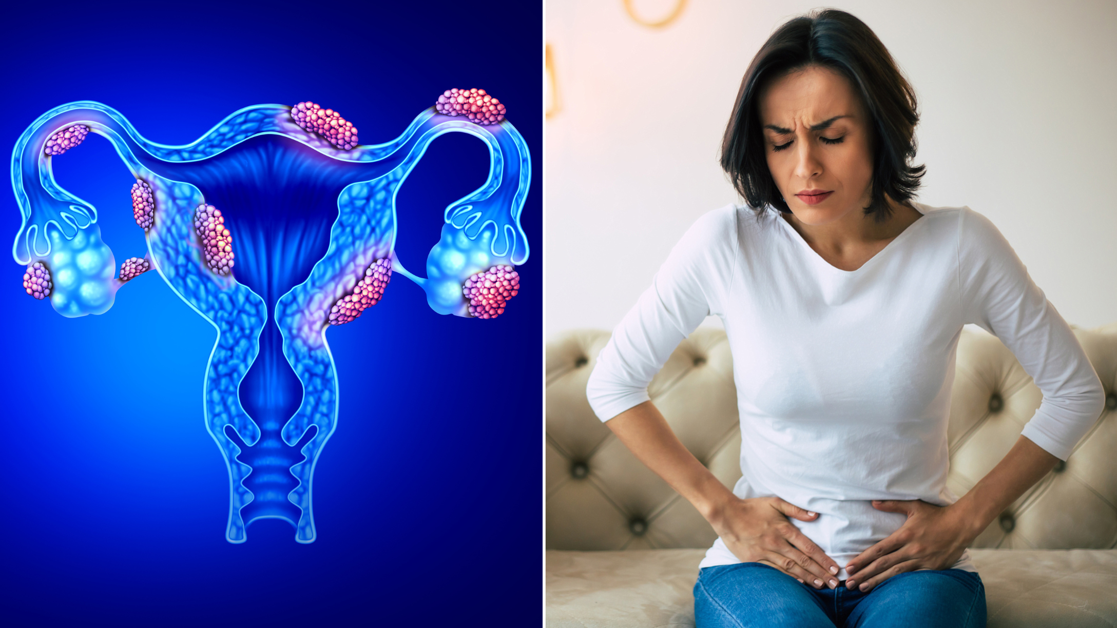 Endometriosis: Qué es, cuáles son sus síntomas y el tratamiento ...