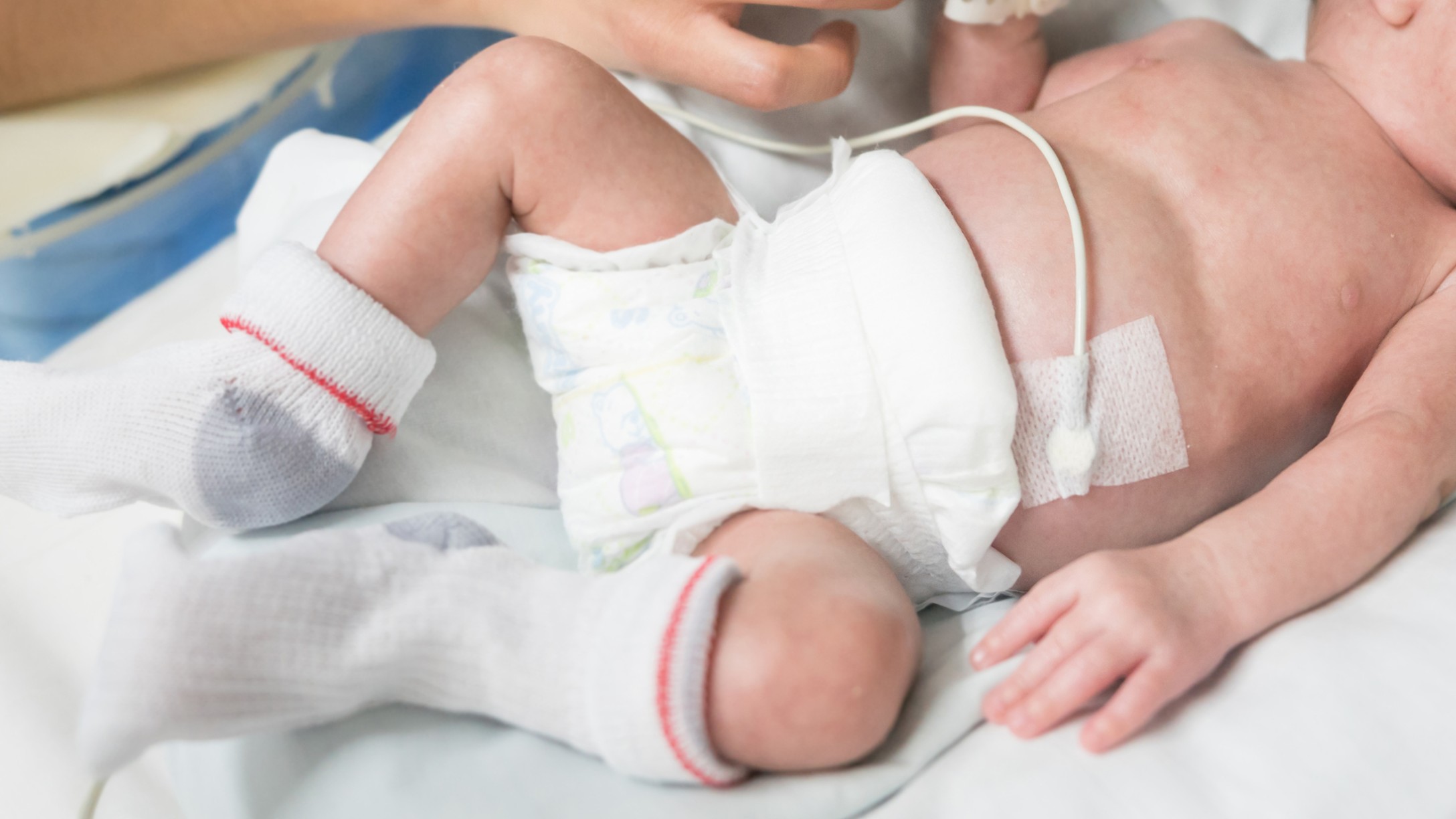 Bebé nace con cola humana de 12 centímetros | MamasLatinas.com