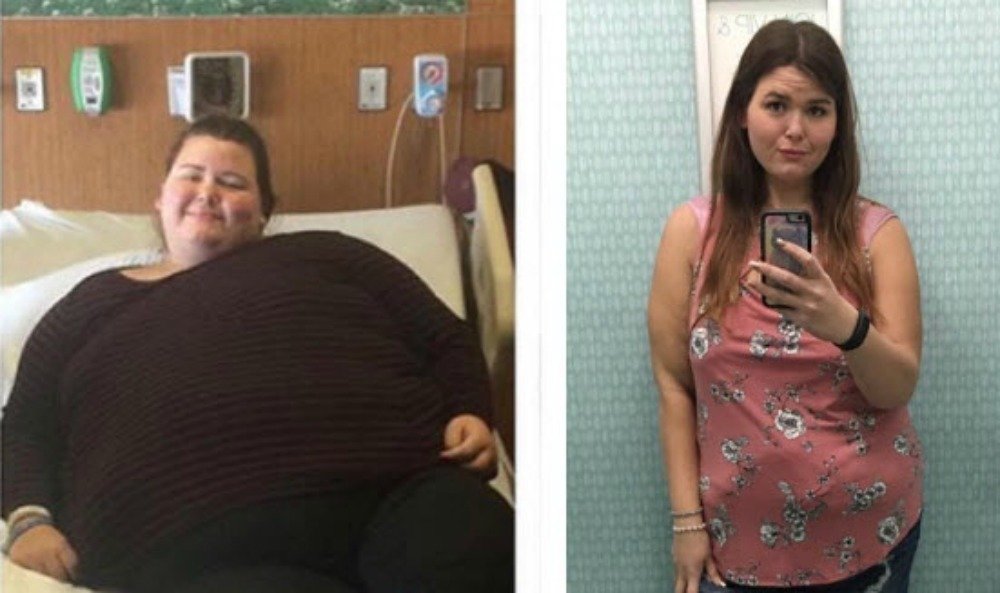 Woman shares photos on Instagram of her excess skin after major weight ...