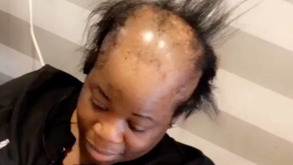 Woman With Alopecia Receives Miracle Hair Transformation Mamaslatinas