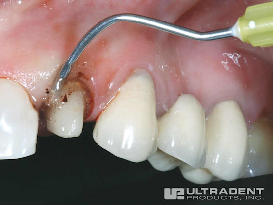 Metal Dento-Infusor™ Tip with Comfort Hub™