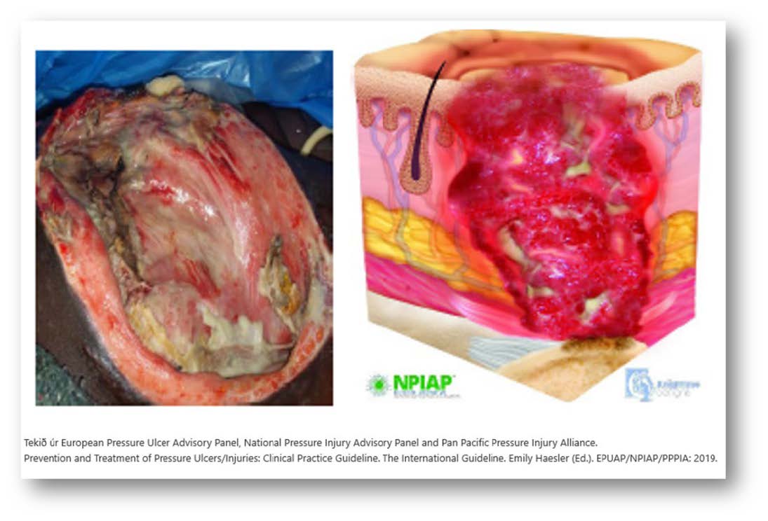do pressure ulcers bleed