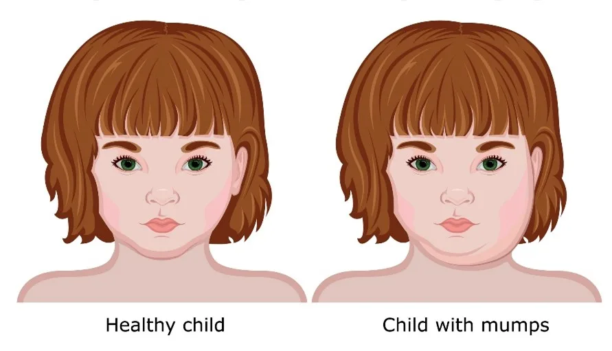 Mumps group infection in the capital area of Iceland | The Directorate ...