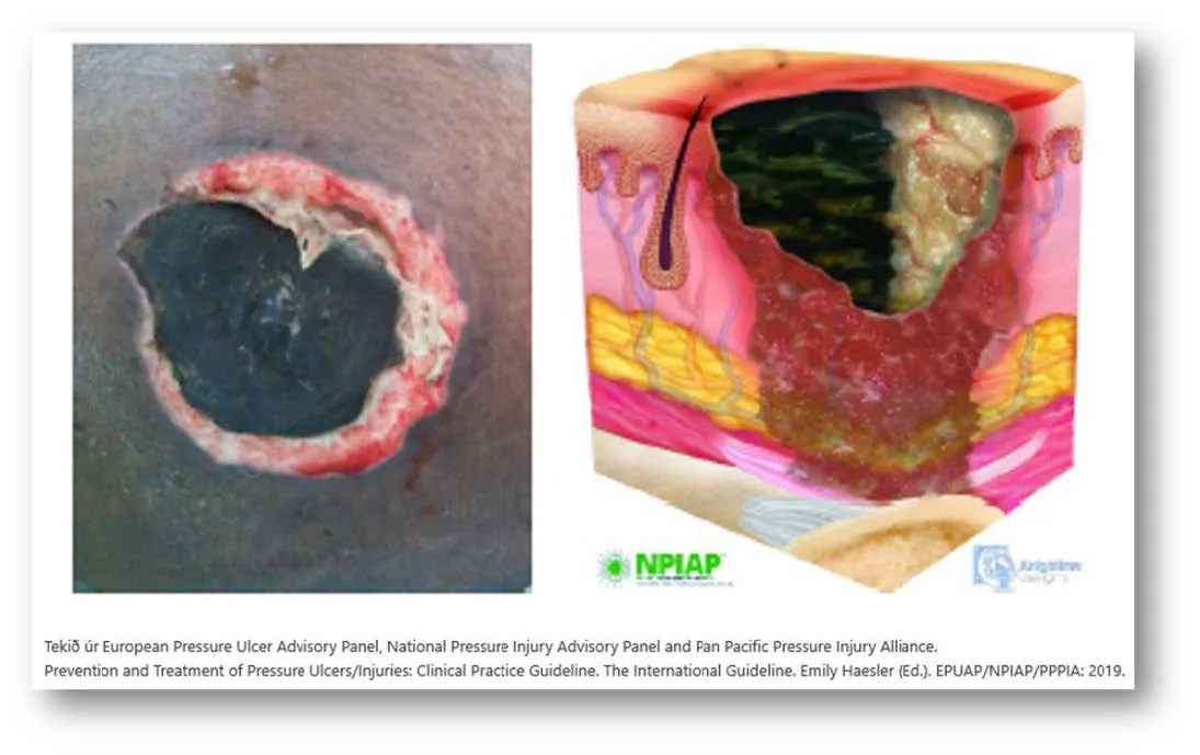 Pressure sore prevention - Consequences, stages and classification ...