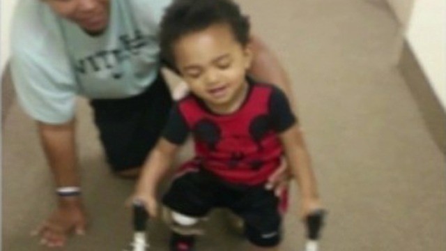 'I got it!' - amputee toddler learns to walk | Good Morning Britain