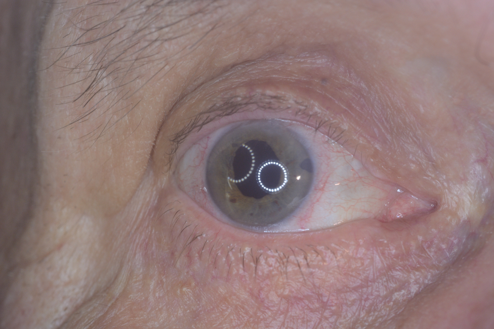What are the Causes of Nystagmus? | LifeMD