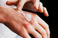Eczema Treatments And Remedies LifeMD