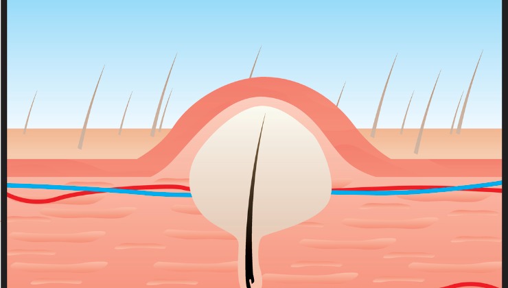 Why Does the Lump on My Head Hurt When I Press it? | LifeMD