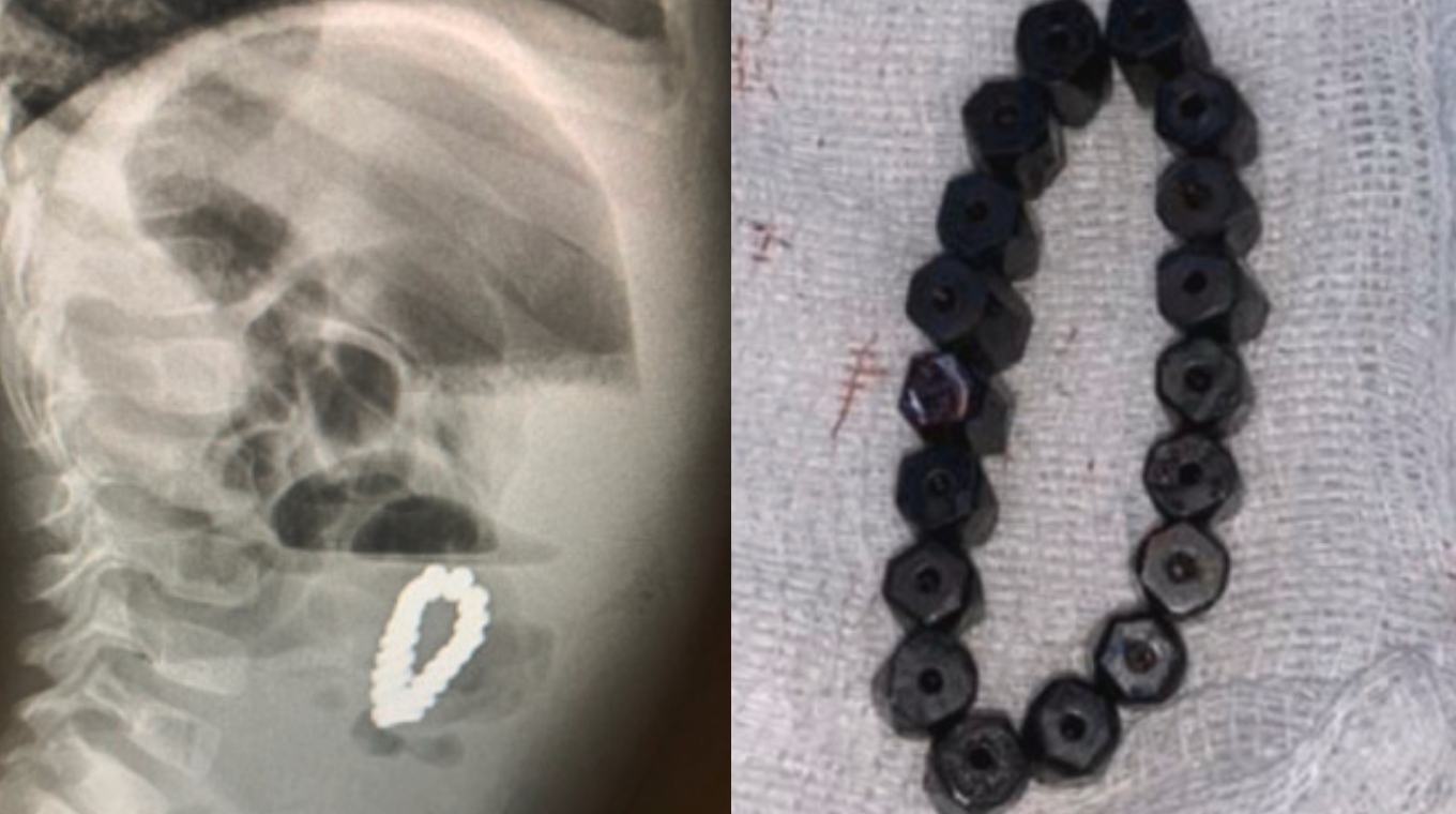 4-Year-Old Swallows Magnetic Bracelet and Suffers Life-Threatening ...