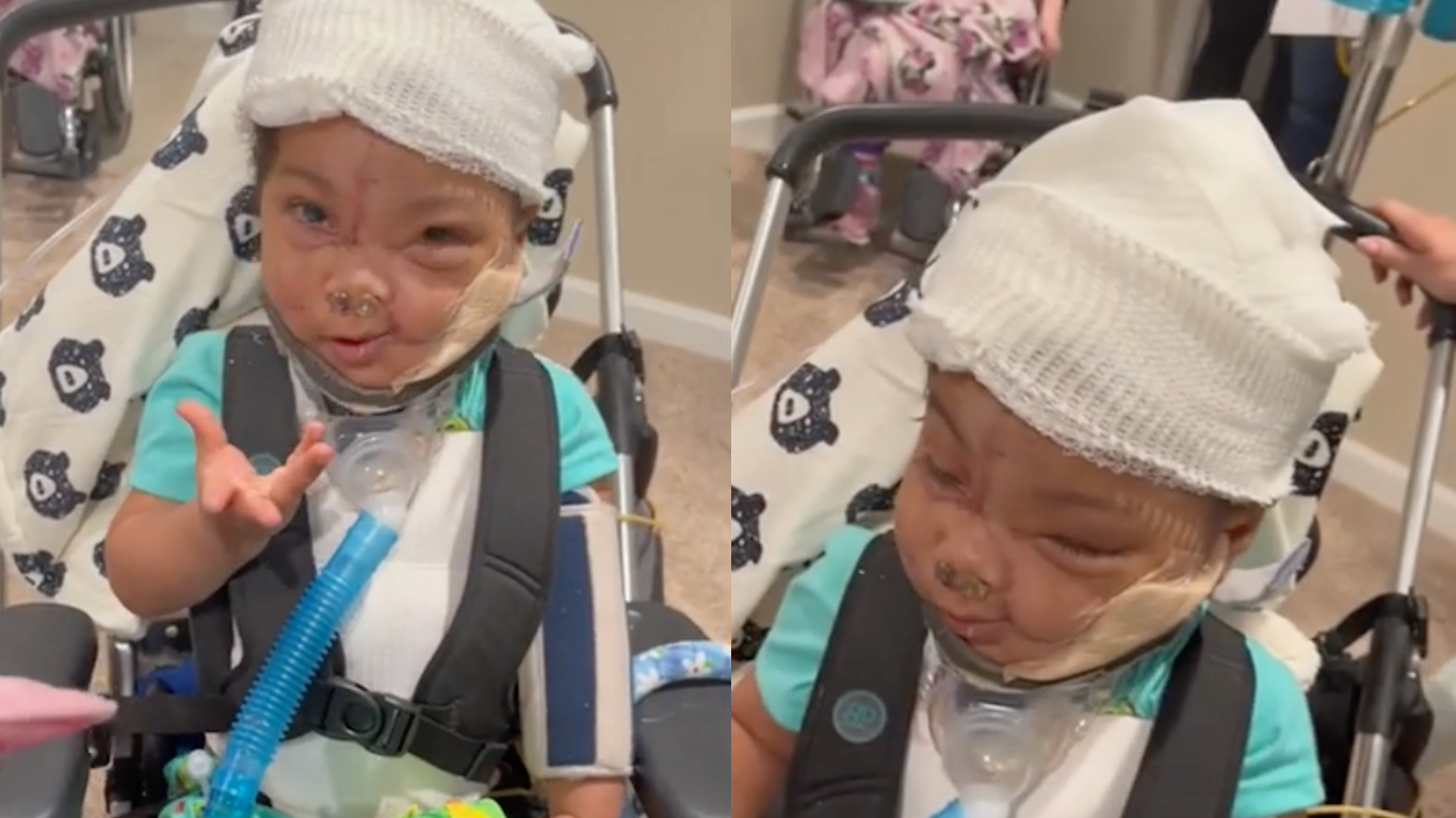 Little Boy Plans for Years of Surgery After Half His Face ‘Ripped Off ...