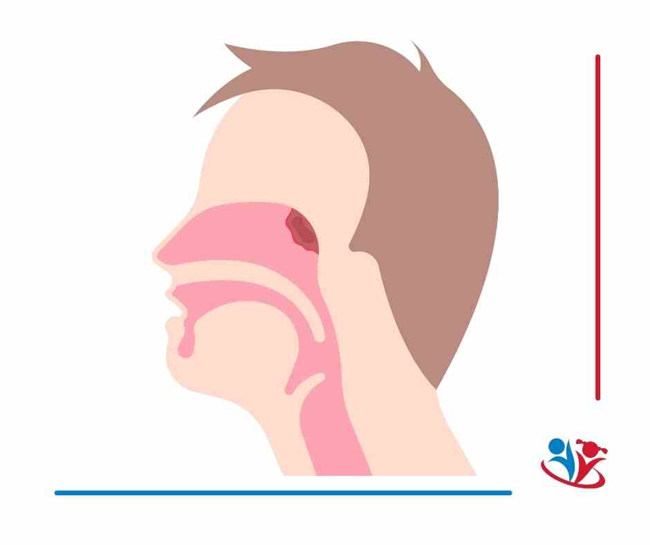 Tumori del Rinofaringe: diagnosi e cura a Firenze – CRO