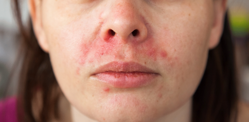 Periorale Dermatitis – Ursachen und Behandlung | MySummer