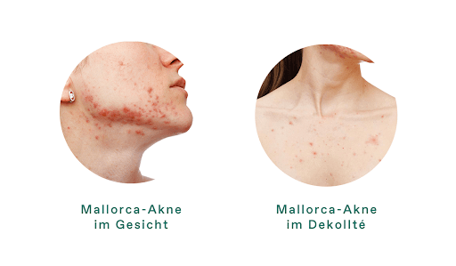 Mallorca-Akne: Definition, Entstehung, Symptome | MySummer