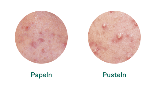 Welche Symptome können bei Akne auftreten? | MySummer