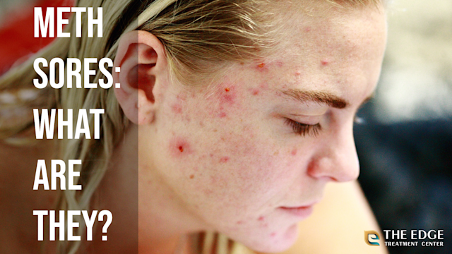 Meth Sores: What are Meth Sores?