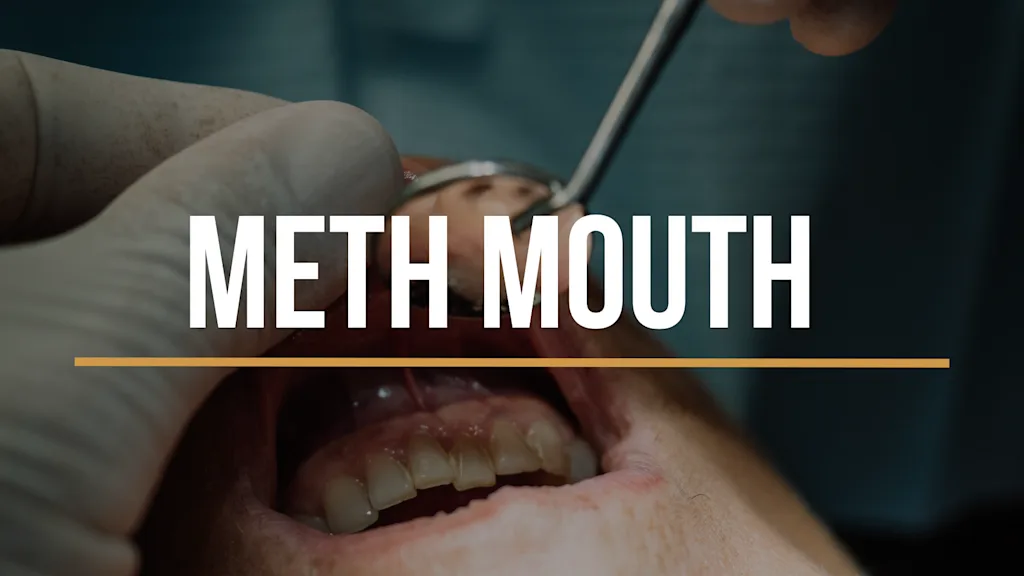 Understanding Meth Mouth: The Dental Impact of Methamphetamine